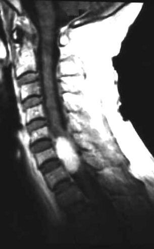 MRI-Library: Neurinom